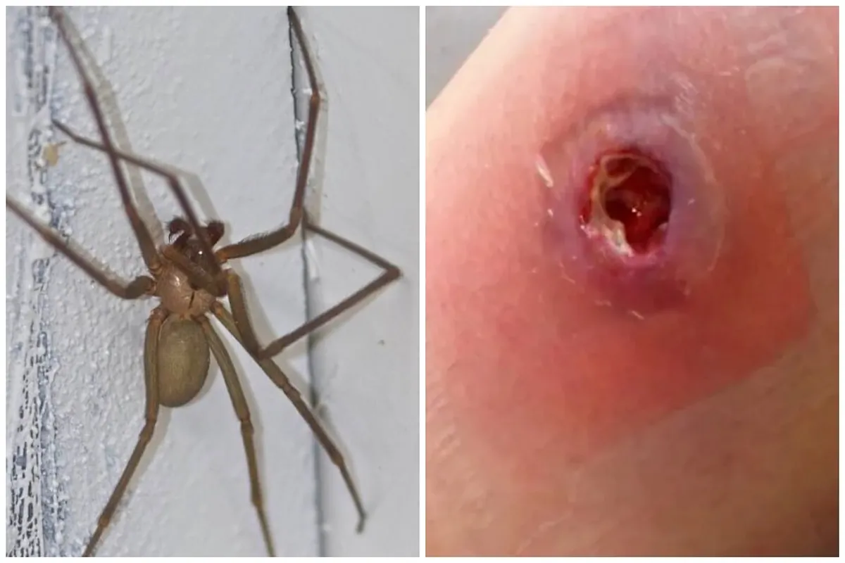 Efectos Secundarios De La Picadura De Araña Reclusa Parda